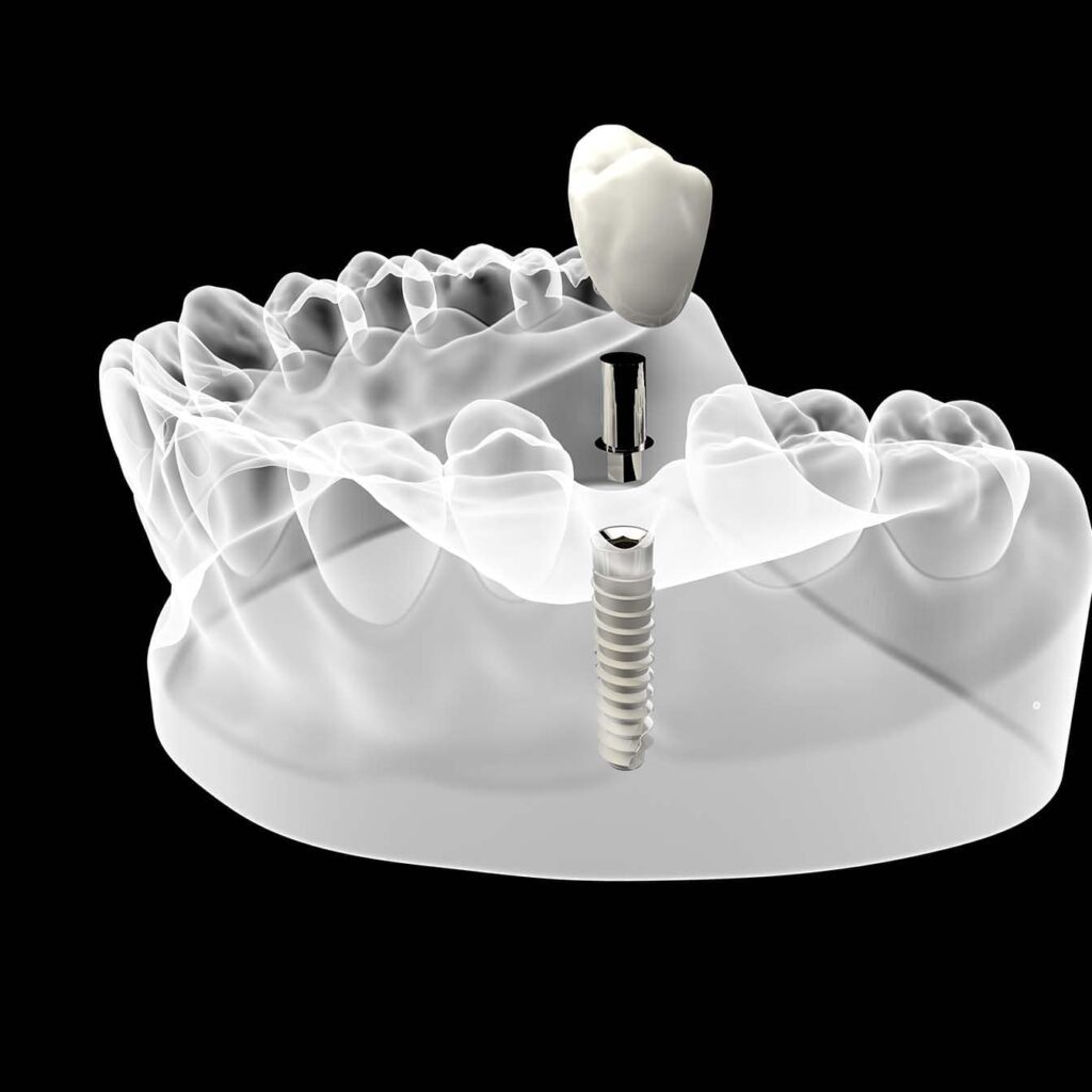 Single Dental Implants - The Dental Implant Institute